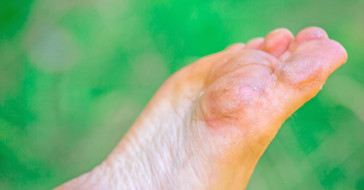 What Are Calluses And How Are They Treated? - Perfect Balance Clinic