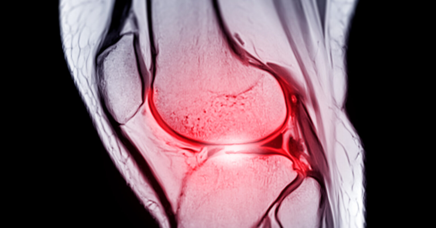 Anterior Cruciate Ligament (ACL) Injury: Repair & Reconstruction