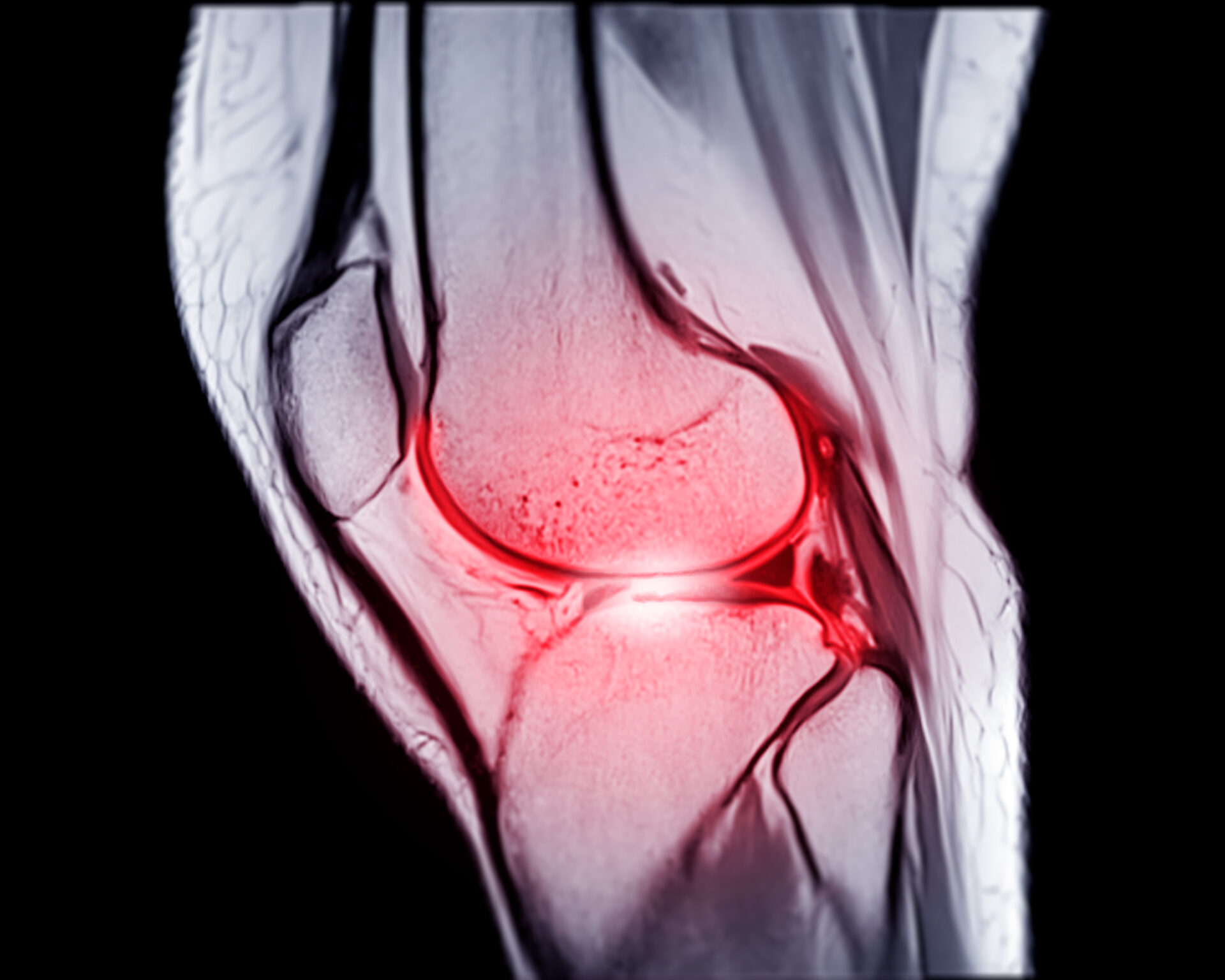 Mri Knee Acl Magnetic Resonance Imaging After Anterior Cruciate