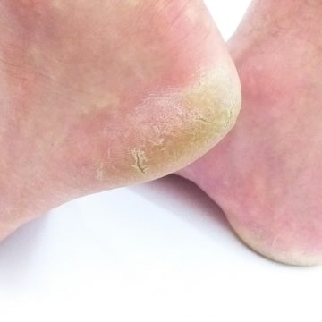 Twisted Pelvic Torsion Diagnosis & Treatment - Perfect Balance Clinic